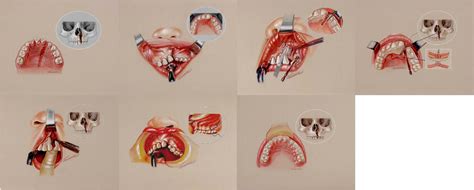 Left Upper First And Second The Alveolar Bone Defect Was Defined The