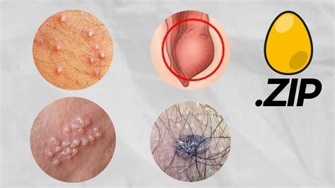 모낭염 바르톨린낭종 헤르페스 생식기 뾰루지 4종 모음 Youtube