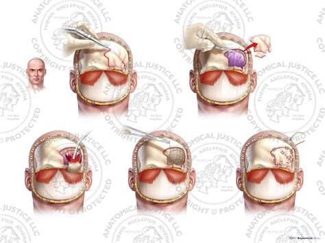 Male Left Frontal Craniotomy And Subdural Hematoma Removal No Text