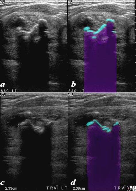 Goiter Multinodular Non Toxic The Common Vein Goiter Multinodular Non Toxic The Common Vein