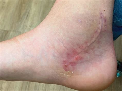 Tarsal Tunnel Release Precise Bioscience Tarsal Tunnel Release Precise Bioscience