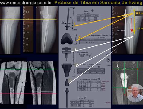 Prótese Da Tíbia Em Sarcoma Ewing Oncocirurgia