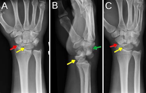 Transscaphoid Perilunate Dislocation