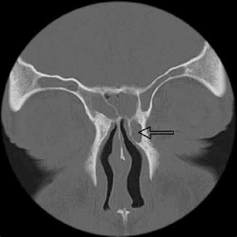 Pdf Influence Of Superior Attachment Of Uncinate Process On Presence Of Agger Nasi