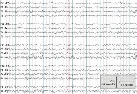 Electroencephalogram Cpt Code Electroencephalogram Cpt Code
