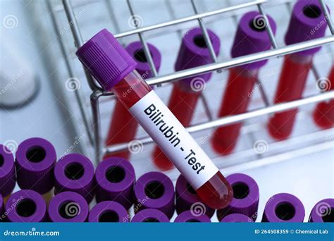 Bilirubin Test To Look For Abnormalities From Blood Stock Image Image