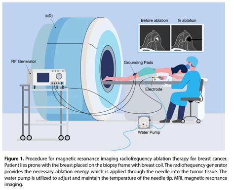 Magnetic Resonance Imaging Guided Radiofrequency Ablation Of Breast