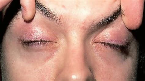 Dermatomyositis Pictures Symptoms Treatment Diagnosis Causes