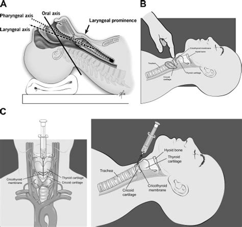 Needle Cricothyrotomy Emergency Medicine Clinics