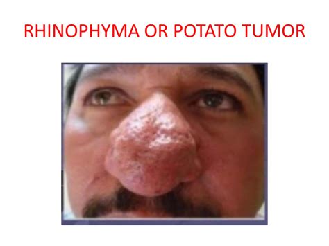 Disease Of External Nose And Nasal Cavity Pptx