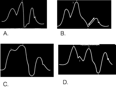 Iabp Abnormal Waveforms Flashcards Quizlet
