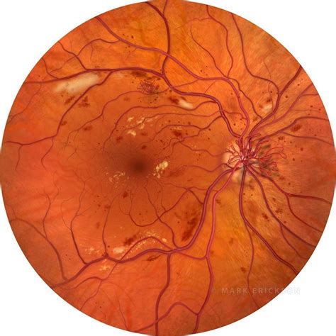 Proliferative Diabetic Retinopathy Fundus Illustration Featuring Nvd And Nve