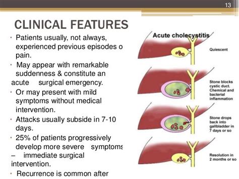 Image Result For Cholecystitis Symptoms Symptoms 10 Things Nurse