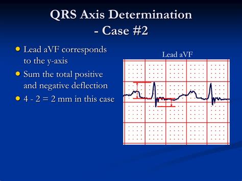 Ppt Ecg Qrs Axis Determination Methods Powerpoint Presentation Free