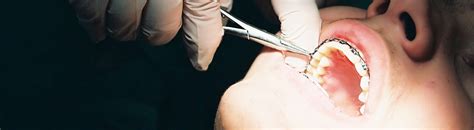 What Is The Iotn Orthodontic Assessment Dentalnotebook