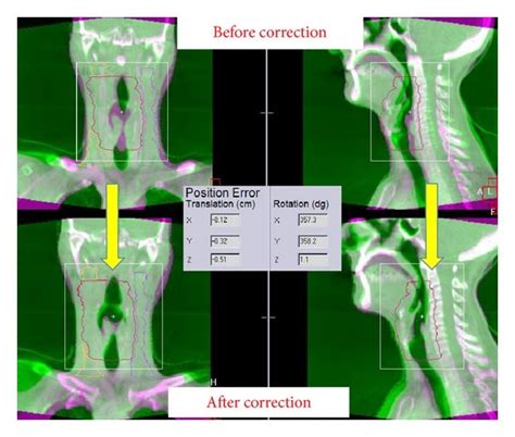 Kv Cbct Volumetric Imaging Both Translational And Rotational Errors Download Scientific