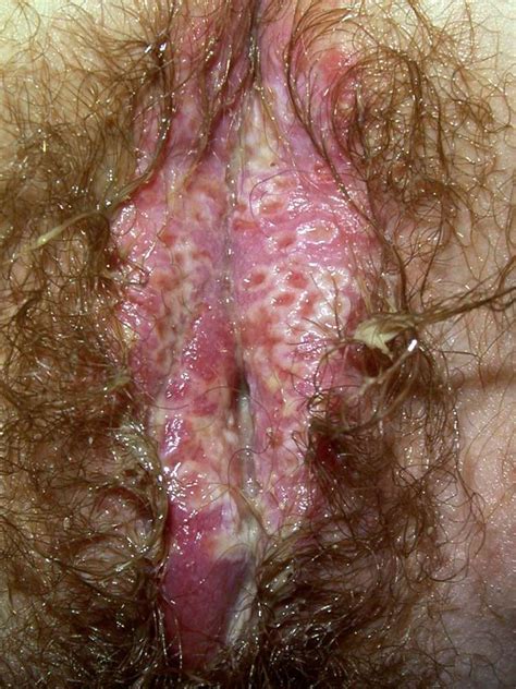 STI Pictures And Symptoms