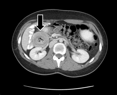 Axial Ct Scan Showing Intussusception Of The Proximal Duodenum Black Download Scientific