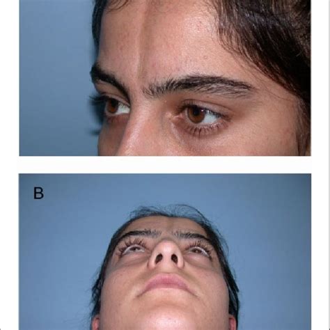 Preoperative View Of The Patient Of Linear Scleroderma A Depressed