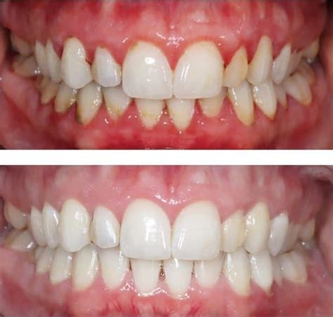 Gingivitis Before And After Deal With Gingivitis Before It Knocks Out