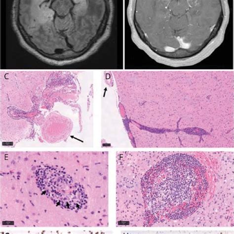Pdf Anti Adenylate Kinase 5 Encephalitis With Histologic Evidence Of