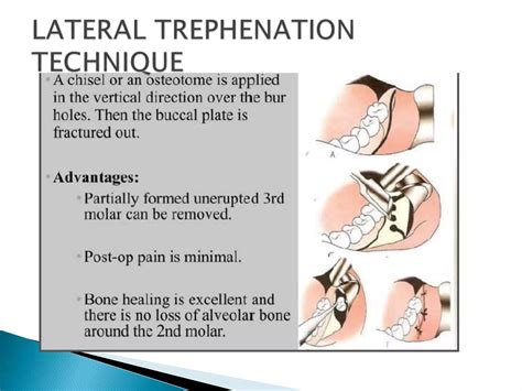 Impaction In Oral Surgery Updatedpptx Free Download