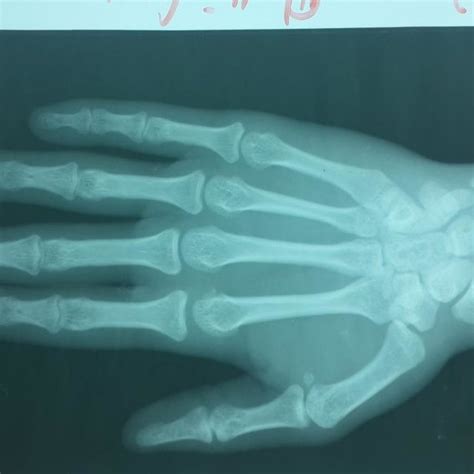 Pdf Dorsal Dislocation Of The Metacarpophalangeal Joint Of The Left Index Finger In A Left