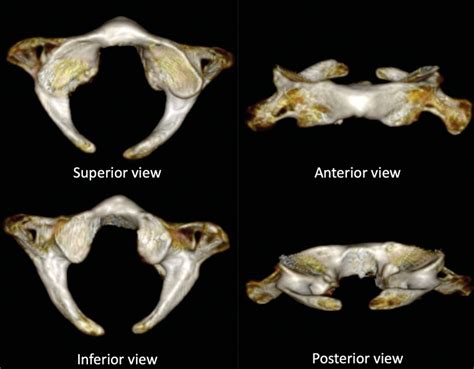 The First Histological Observation Of A C1 Posterior Arch Defect Fang