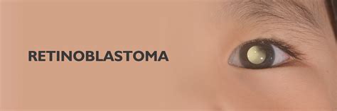 Retinoblastoma Symptoms Chect Uk On X Its National Eye Health Week
