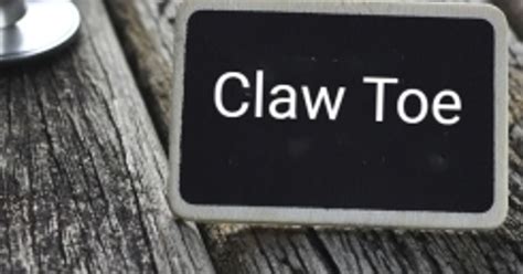 What Is Claw Toe Facty Health