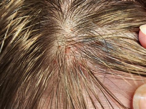 Dry Scalp Any Product Suggestions Rfemalehairadvice