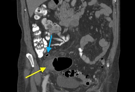 14 Mimics Of Appendicitis