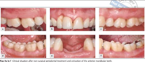 Figure 18 From Necrotising Periodontal Diseases Necrotising