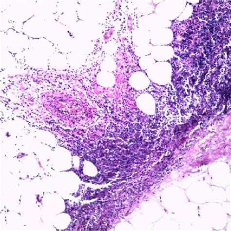 Pyoderma Gangrenosum Large Purulent Ulcer With Violaceous Undermined