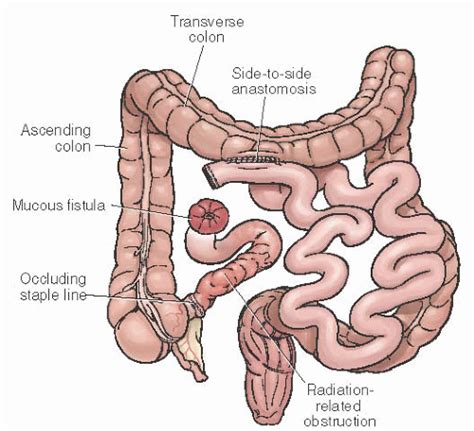 Mucous Fistula And Ileostomy