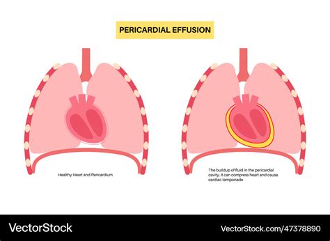 Pericardial Effusion