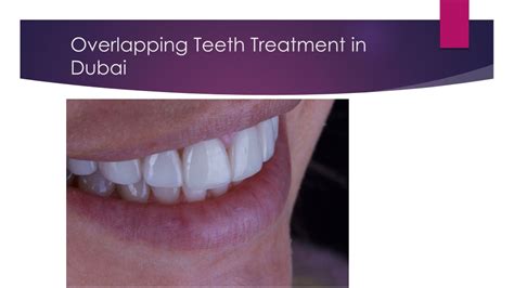 Ppt Overlapping Teeth Treatment In Dubai Powerpoint Presentation