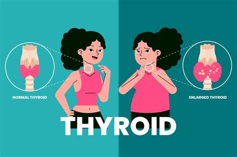 Thyroid Hyperthyroid Foresthills Newyork Drc Caulocare Thyroikd