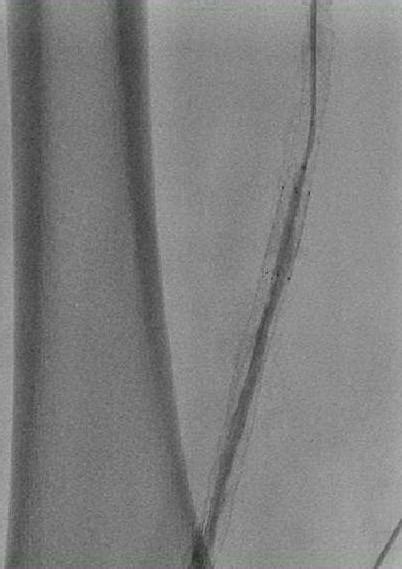 Angiogram Of The Right Sfa After Balloon Angioplasty Showing Download Scientific Diagram