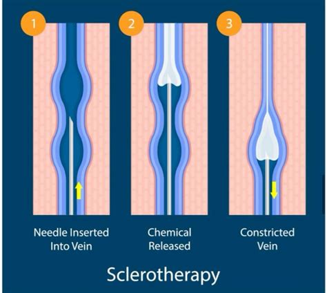 Spider Vein Sclerotherapy What Is Sclerotherapy Artofit