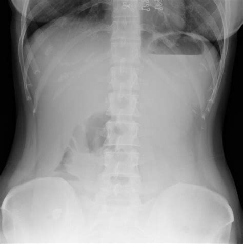 Radiopaedia Case Perforated Appendicitis With Appendicolith Id 12824