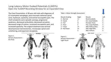 Long Latency Motor Evoked Potentials Llmeps Open The Tcemep Recording Window For An Expanded