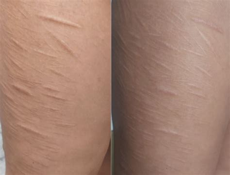 Transform Self Harm Scars With Medical Tattooing