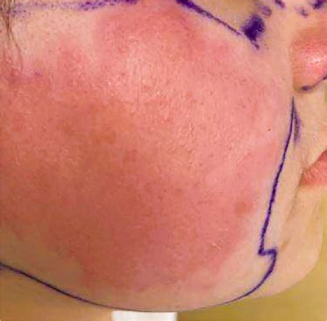 Rapidly Progressing Facial Rash Aafp
