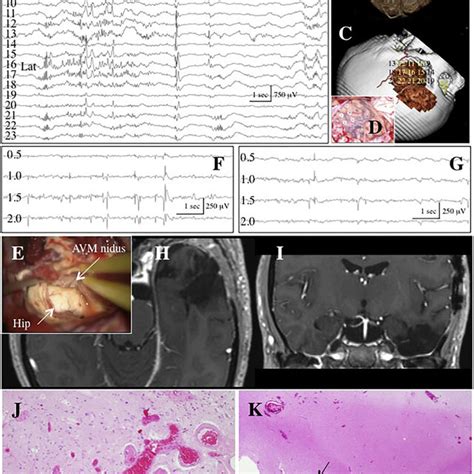 A Intraoperative Electrocorticography Ecog Of The Lateral Lat