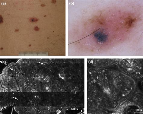 Junctional Melanocytic Nevus Junctional Melanocytic Nevus