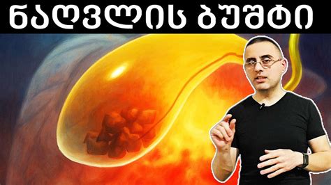 ნაღვლის ბუშტის ტკივილი მიზეზები და მკურნალობა Youtube