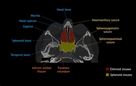 Sphenoid Bone Labeled
