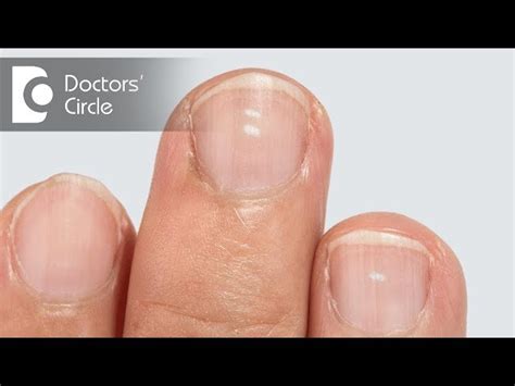 White On Fingernails Deficiency White On Fingernails Deficiency