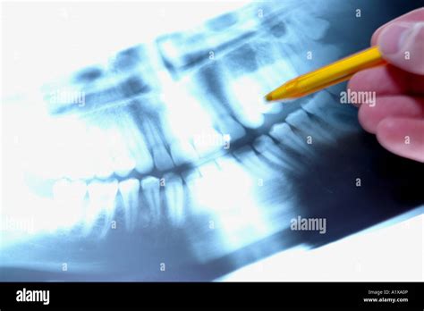 X Ray Of The Teeth Stock Photo Alamy